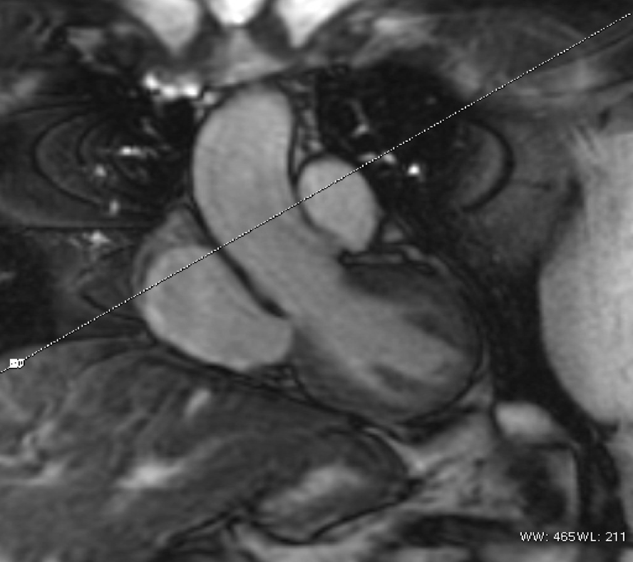Aortic Regurgitation - Cardiac MRI