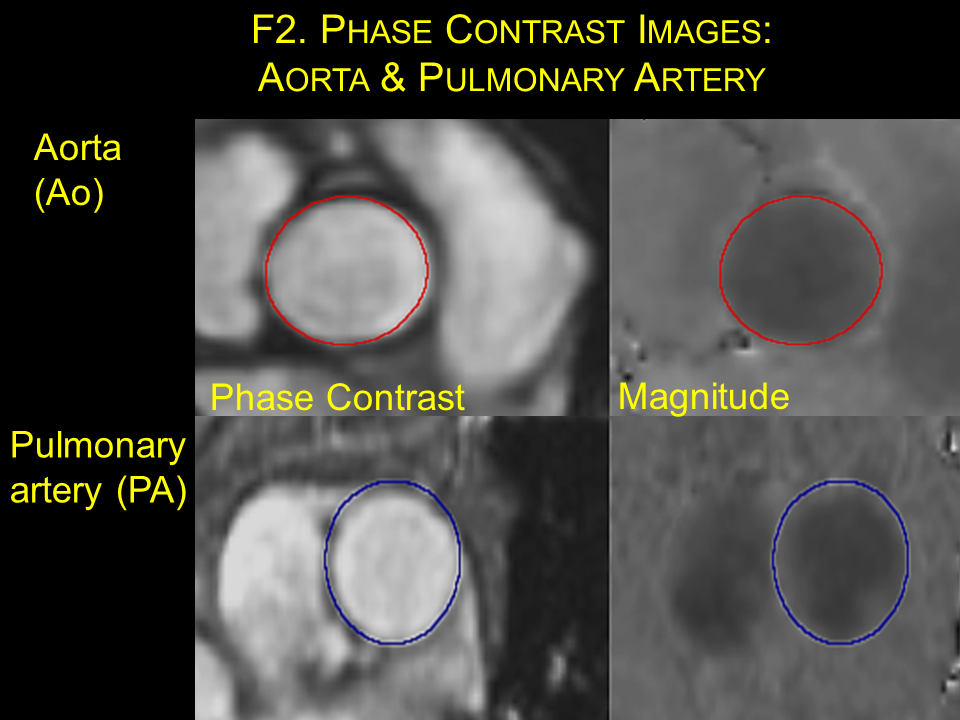 Aortic regurgitation - Cardiac MRI