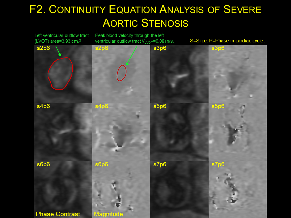 Aortic stenosis - Cardiac MRI