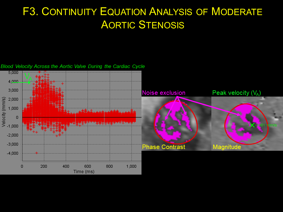 Aortic stenosis - Cardiac MRI