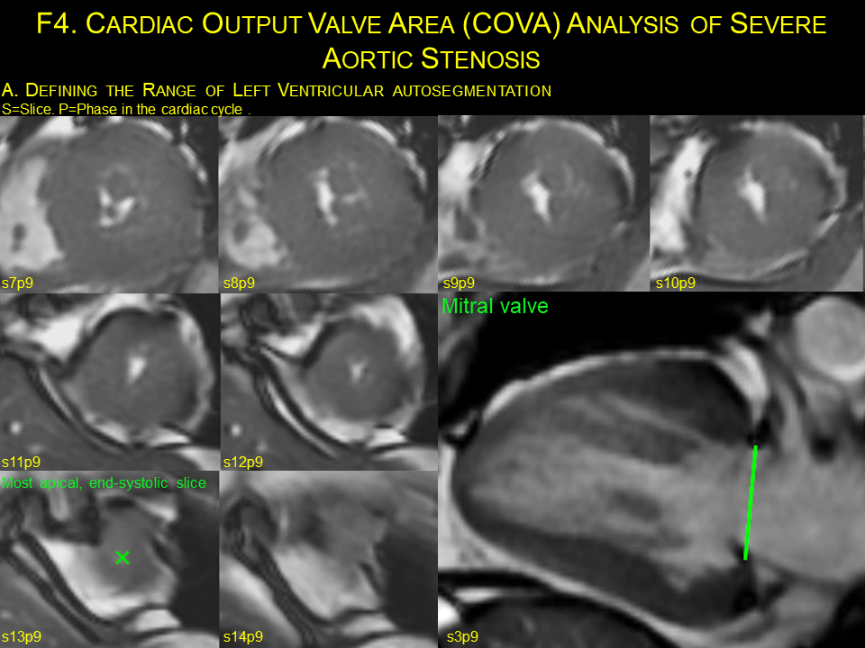 Aortic stenosis - Cardiac MRI