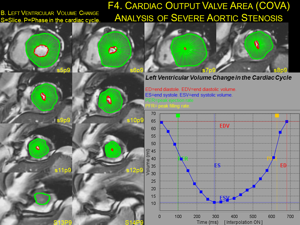 Aortic stenosis - Cardiac MRI