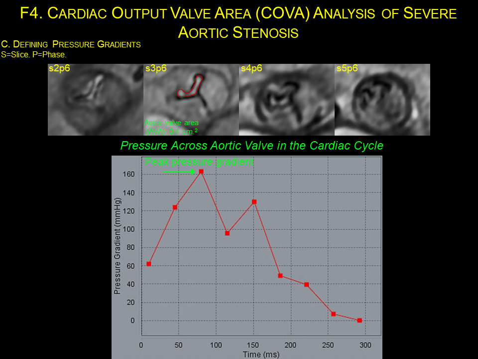 Aortic stenosis - Cardiac MRI