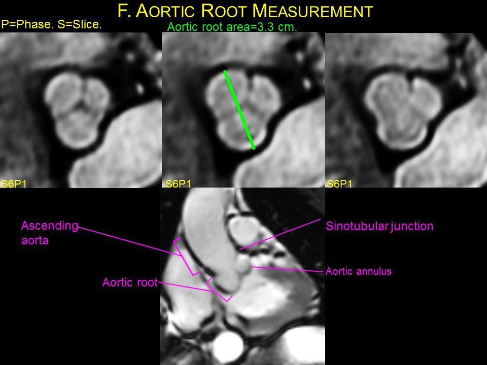 Aortic Root - Cardiac MRI