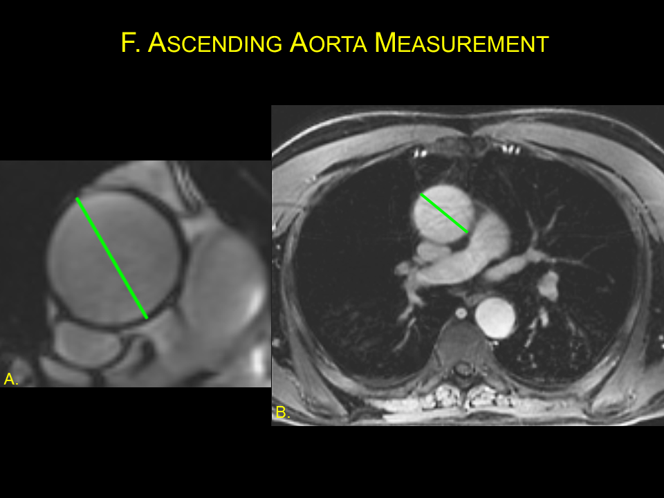 Ascending aorta - Cardiac MRI