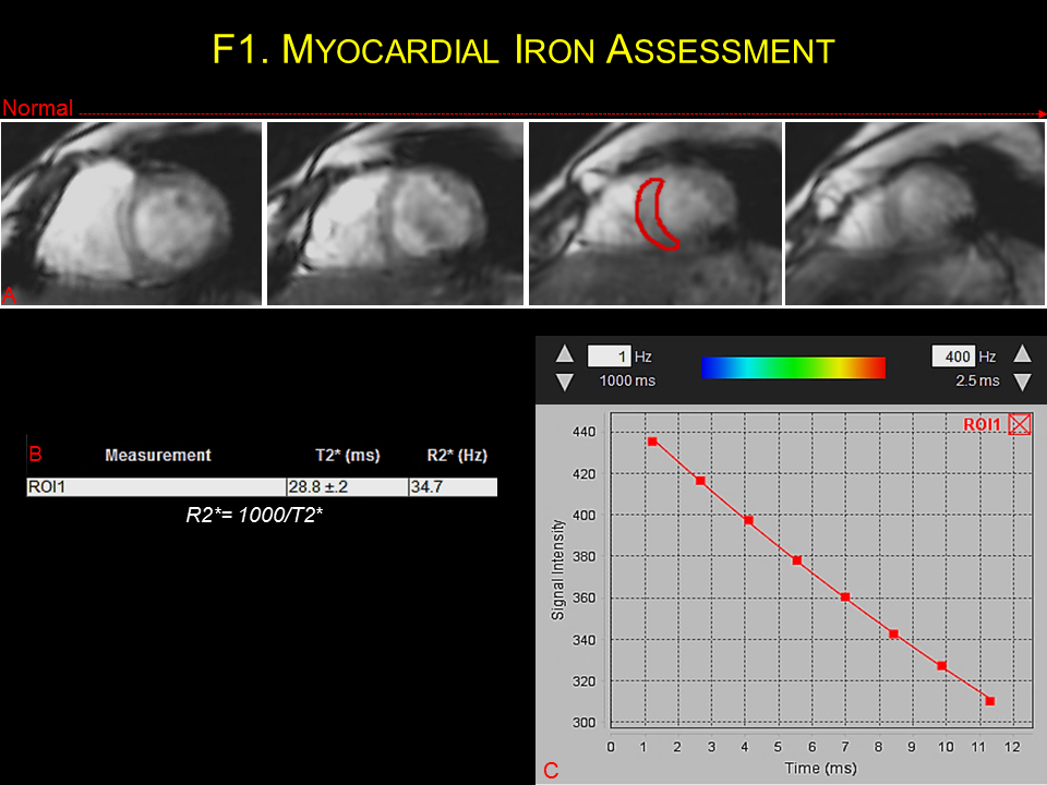 Myocardial Iron Assessment - Cardiac MRI