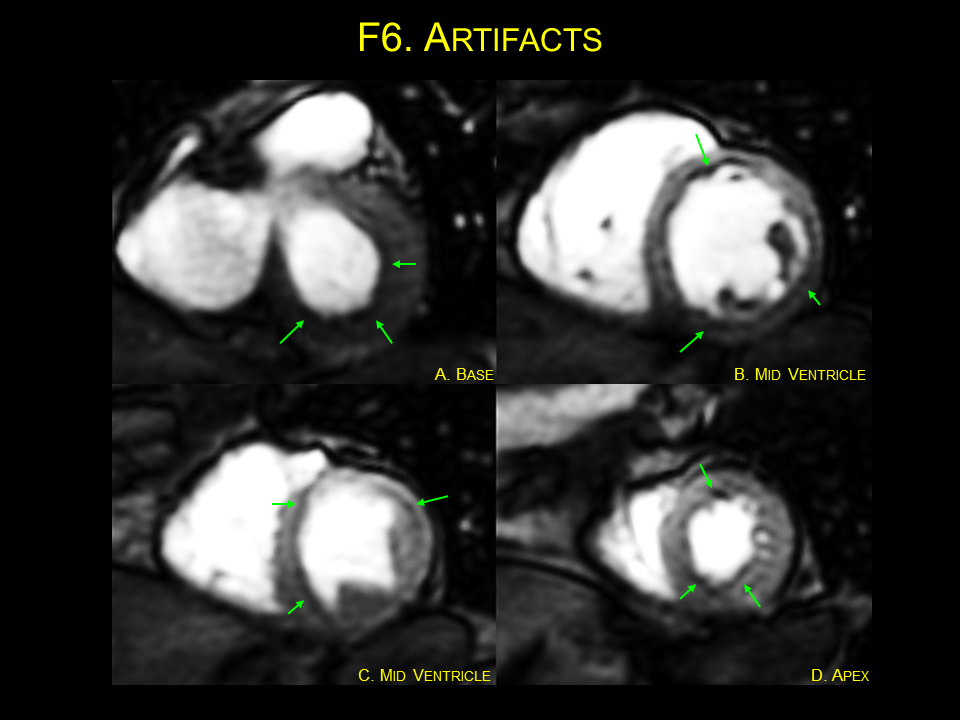 Myocardial Perfusion - Cardiac MRI